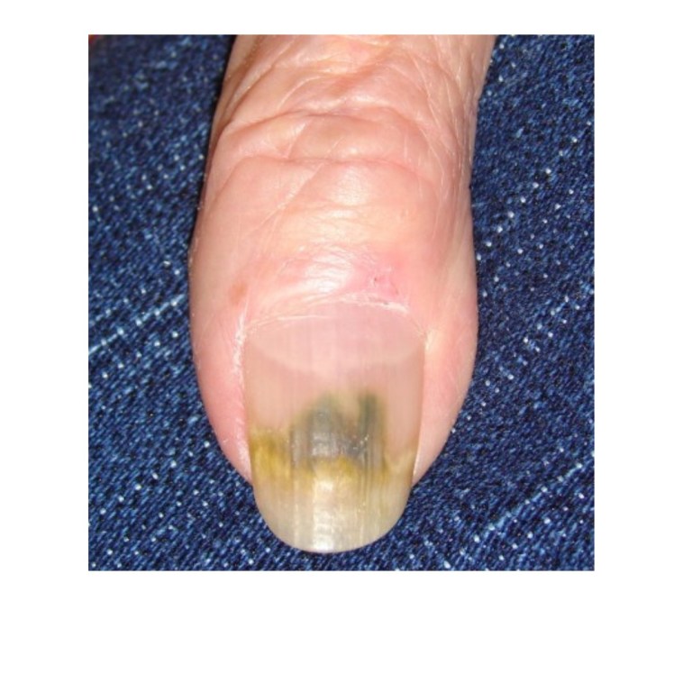 What is Chloronychia, or nail greenies?